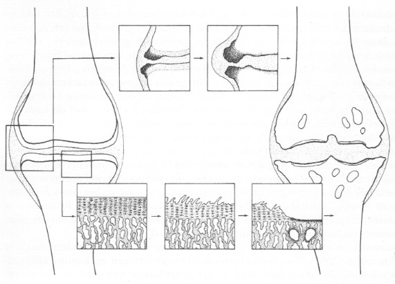 Artrose klachten: wat is het en wat kun je er tegen doen?