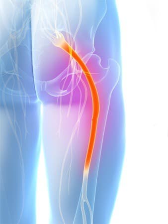 Wat is ischias? Oorzaken, symptomen en behandeling